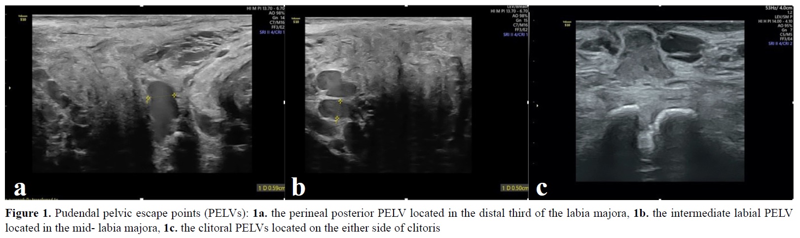 Pelvic escape points: Bottom- up is the way to go!