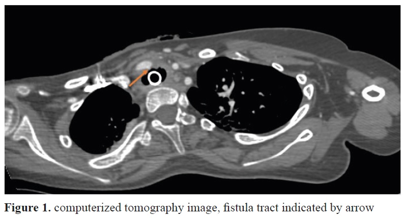 Endovascular aortic repair with Cardiatis® multilayer flow modulator in ...