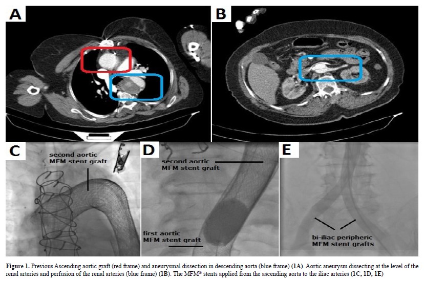 Planning the Treatment of Chronic Venous Insufficiency